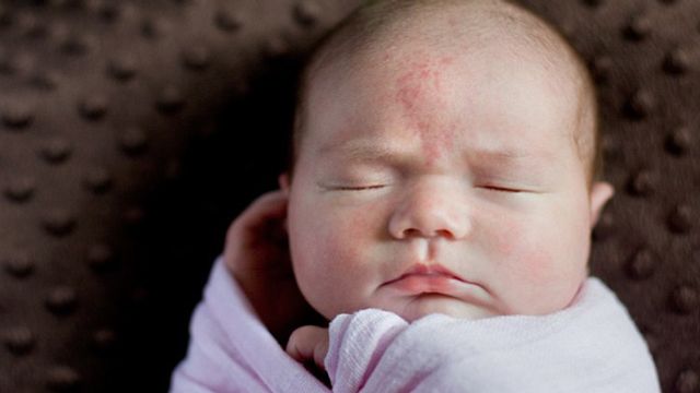 A Parent's Quick Guide to Birthmarks