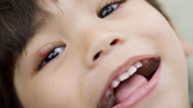 Stye or Kuliti: Depinisyon, Sanhi at Paggamot